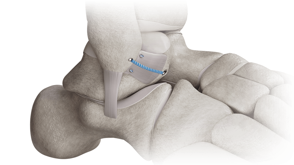 带线锚钉修复跟腱断裂 | 术式 | REJOIN 锐健