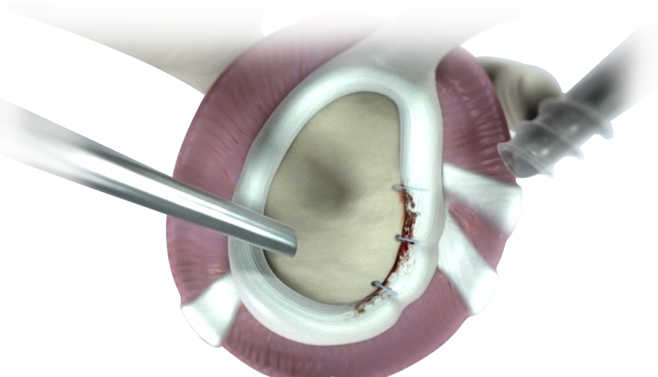 全缝线锚钉肩不稳修复术 | 术式 | REJOIN 锐健